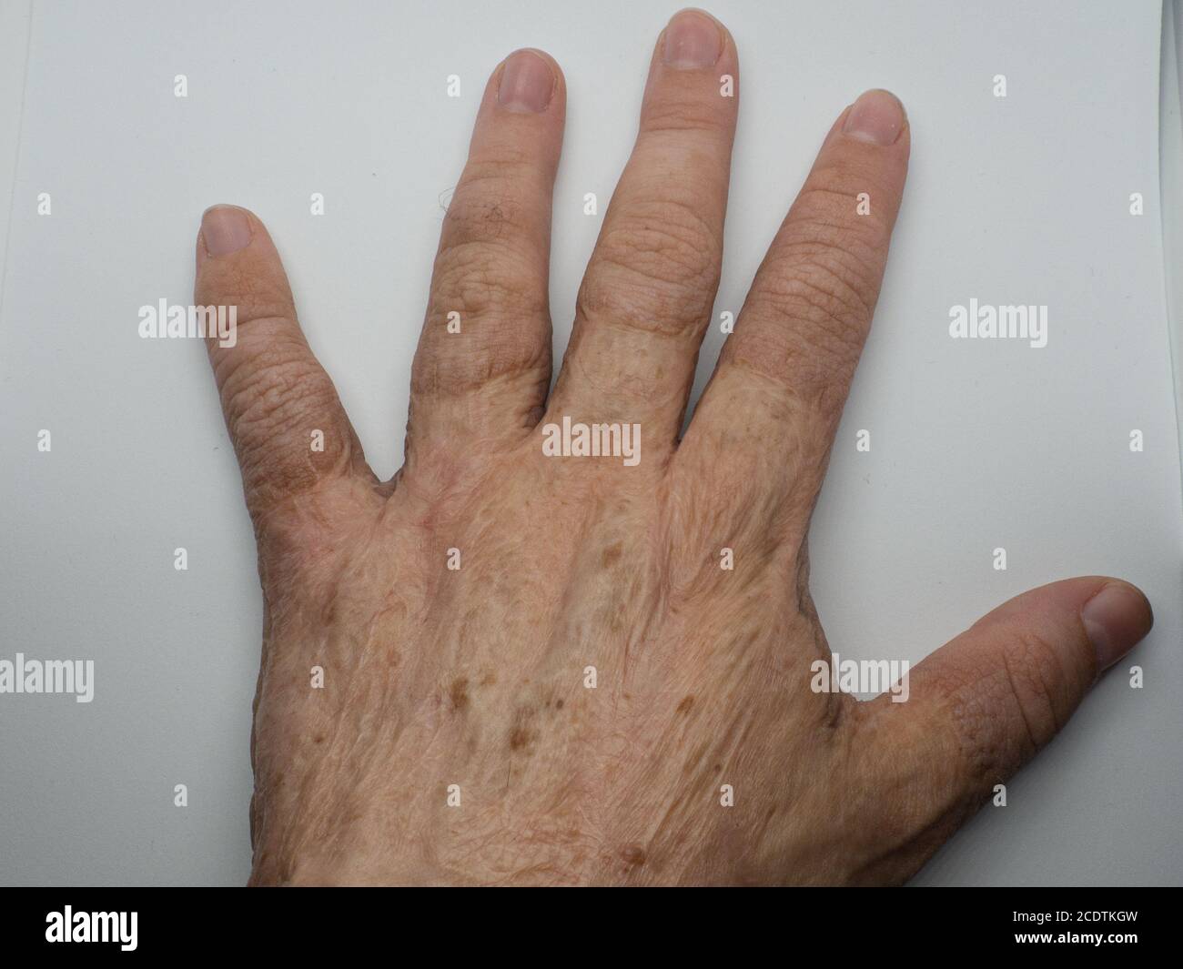 Skin graft hi-res stock photography and images - Alamy
