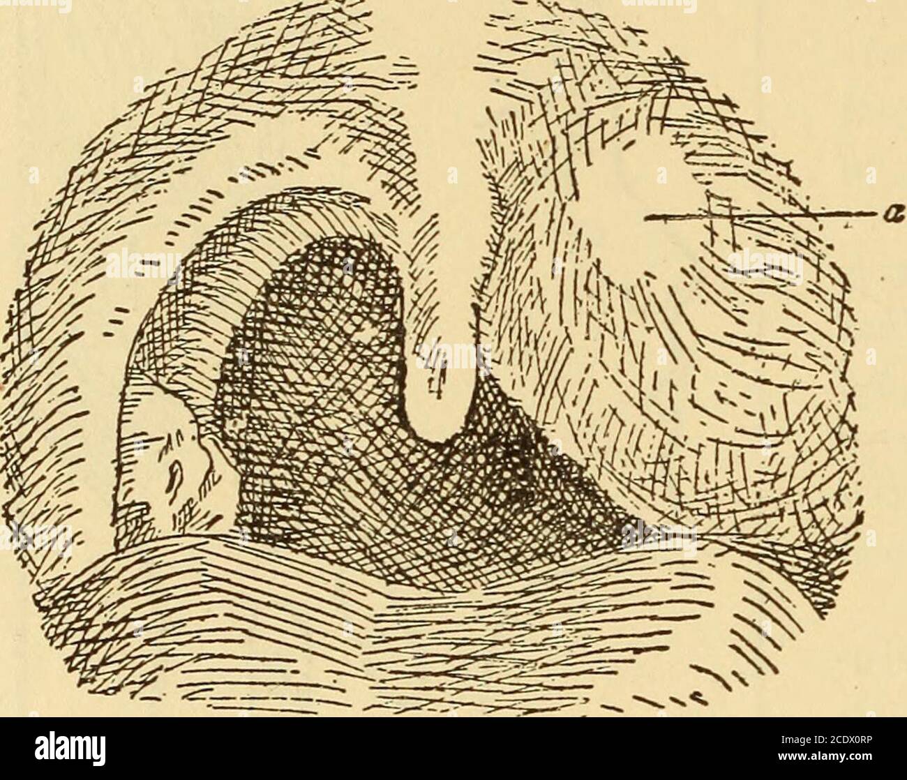 Pharynx diphtheria hi-res stock photography and images - Alamy