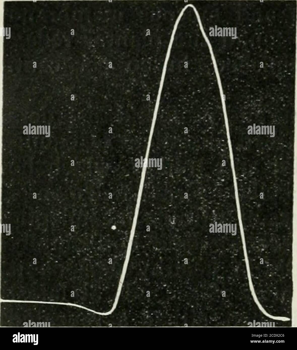 . Dementia praecox and paraphrenia . Fig. 14.Simple Finger Movement in ...