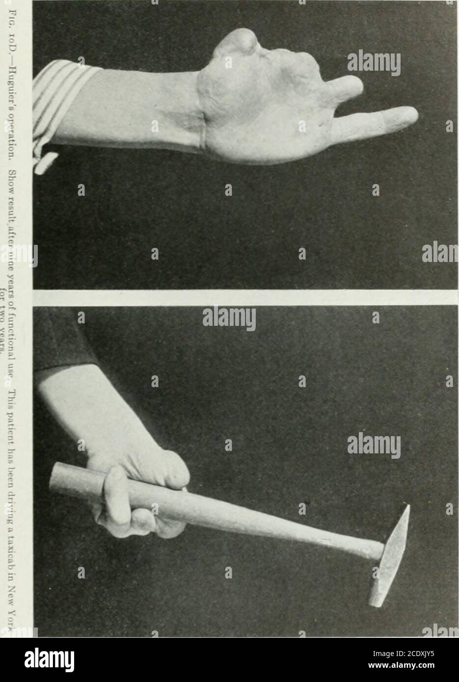 . Annals of surgery . 840 TREATMENT OF DISABILITIES OF THE HAND. 841 ...