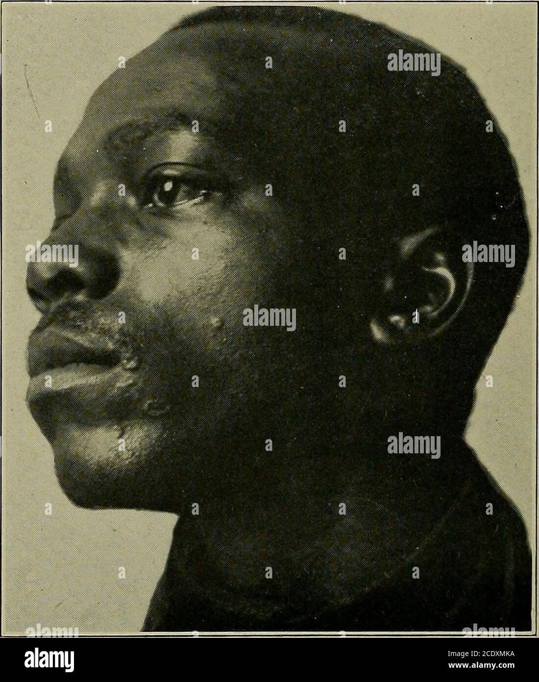 Annular lesions hi-res stock photography and images - Alamy