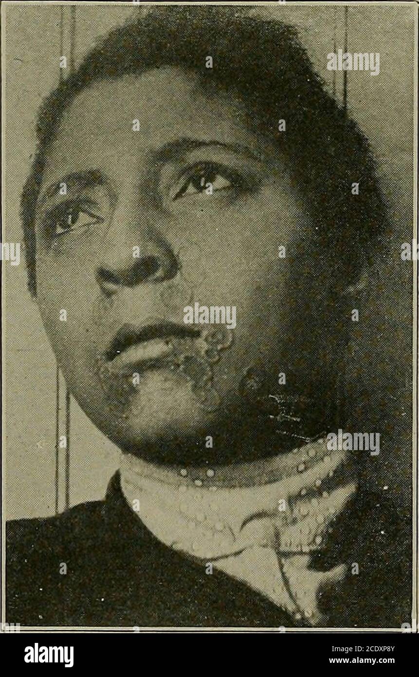 Annular lesions hi-res stock photography and images - Alamy