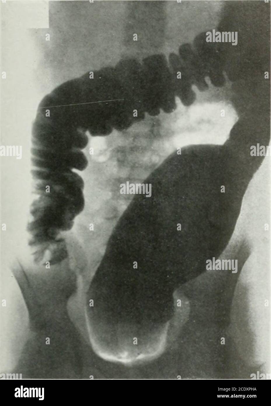 Megacolon hi-res stock photography and images - Alamy