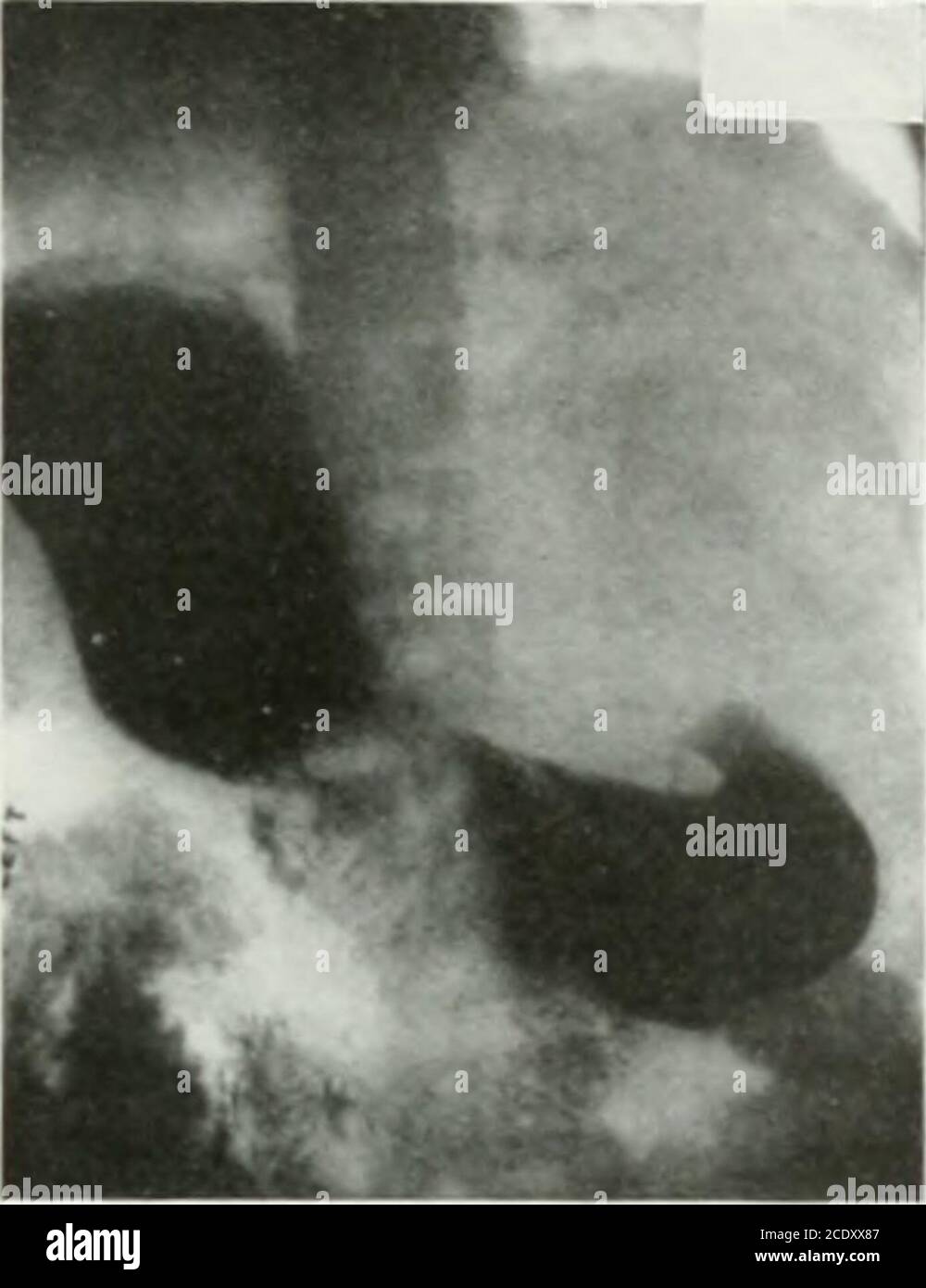 Transverse mesocolon hi-res stock photography and images - Alamy