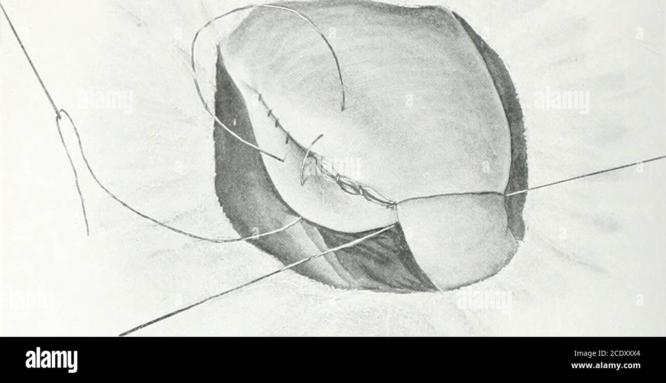 . Annals of surgery . Insert shows posterior suture line. RICHARD ...