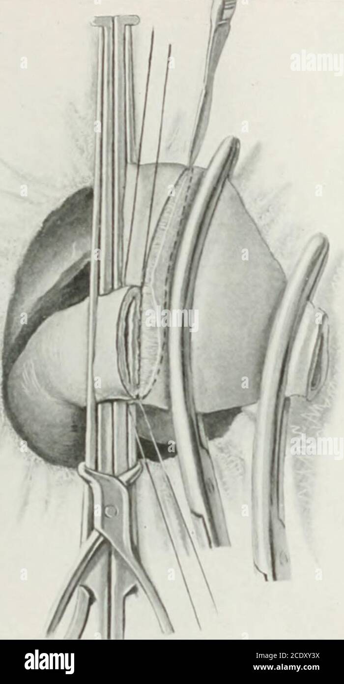 Clamp placed on stomach hi-res stock photography and images - Alamy