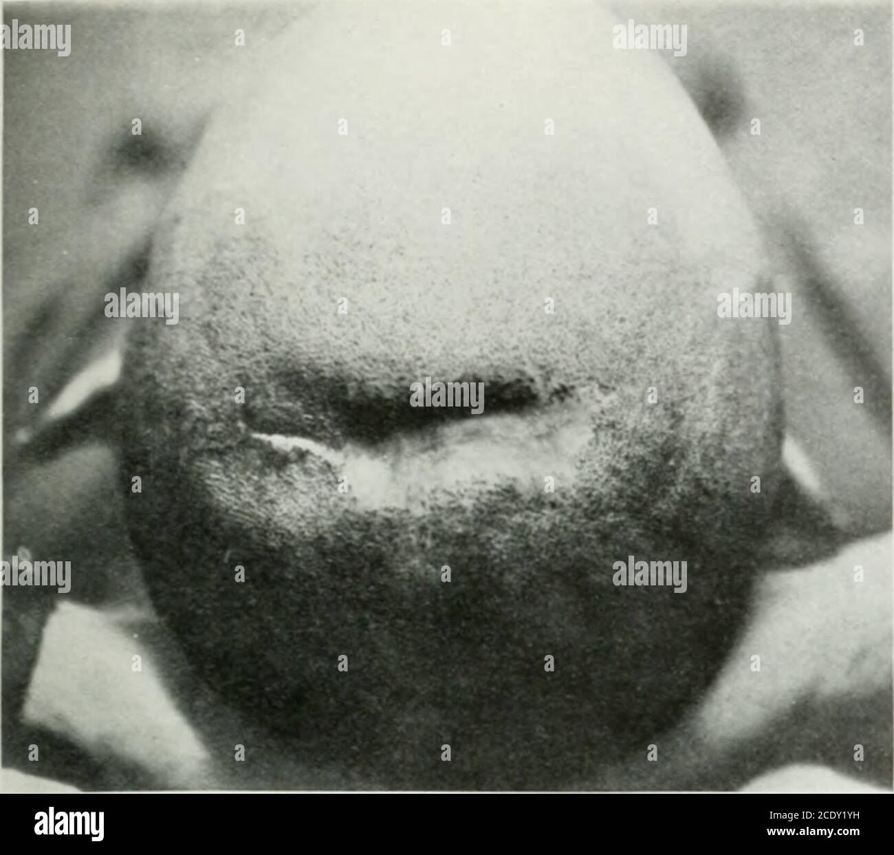 . Annals of surgery . alcohol dressing is reapplied on the lourth and ...