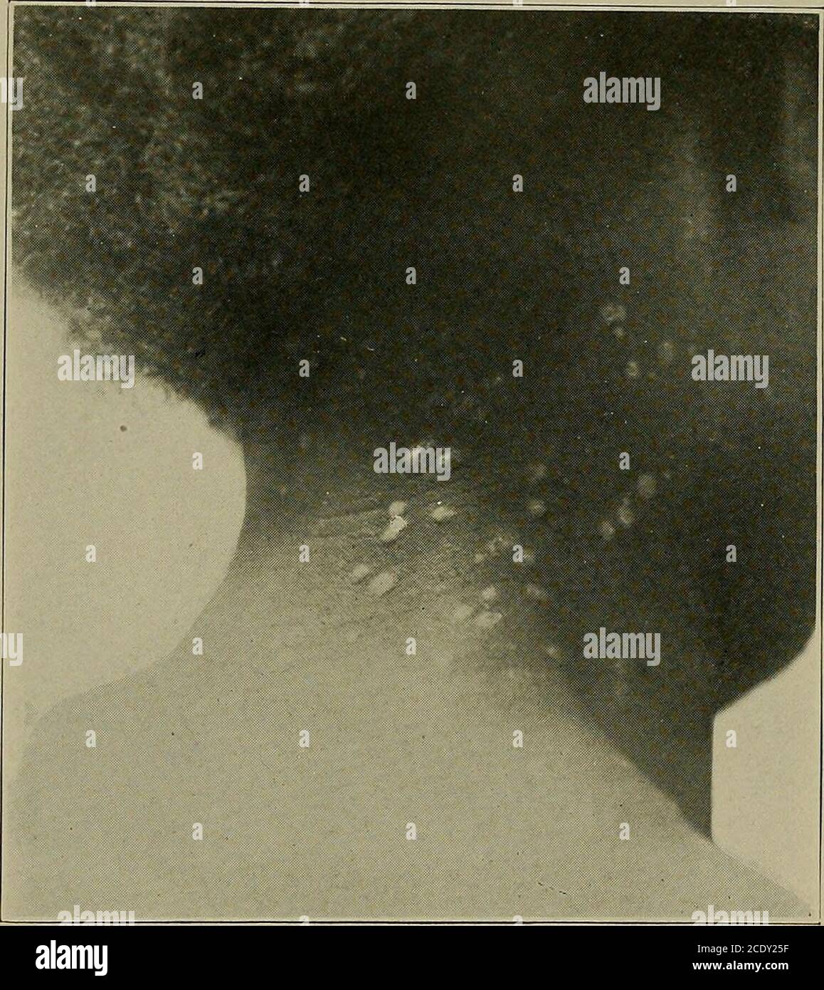 . Syphilis : a treatise on etiology, pathology, diagnosis, prognosis ...