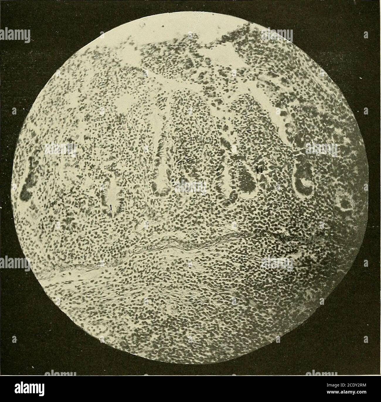 Congenital syphilis hi-res stock photography and images - Alamy