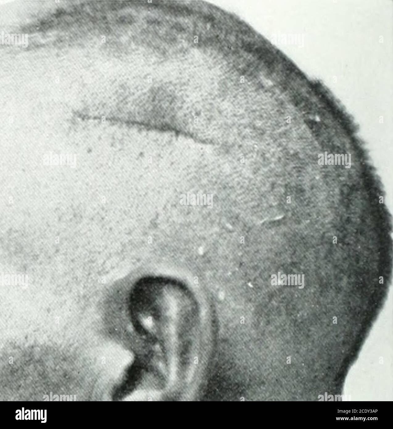 Pathologic fracture hi-res stock photography and images - Alamy