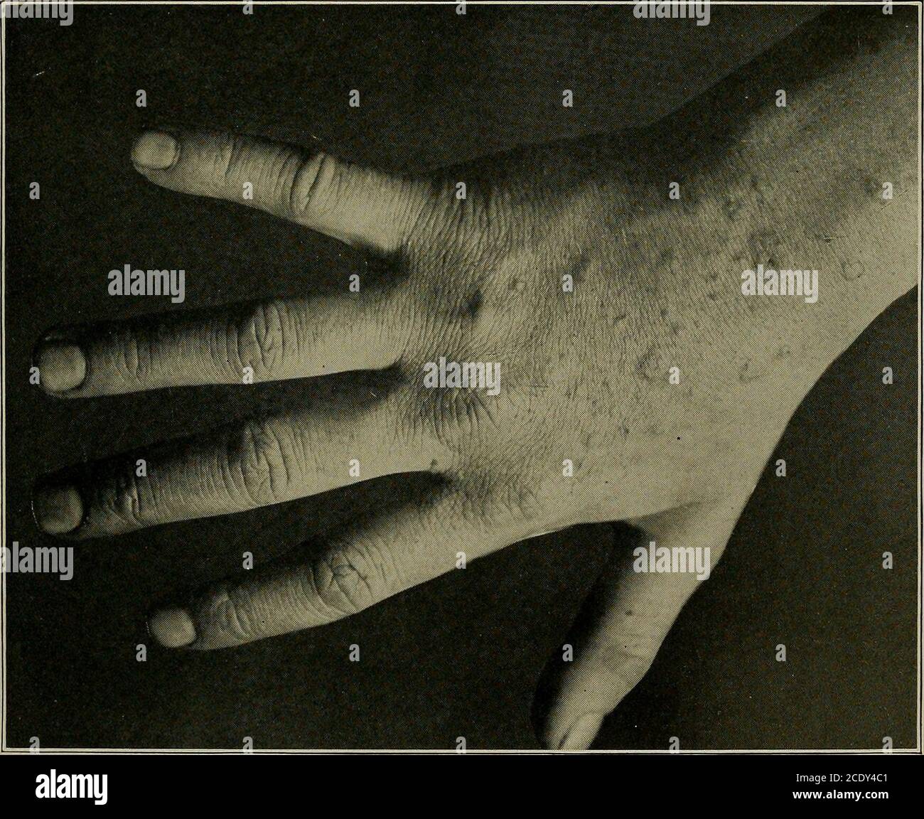 . Syphilis : a treatise on etiology, pathology, diagnosis, prognosis ...