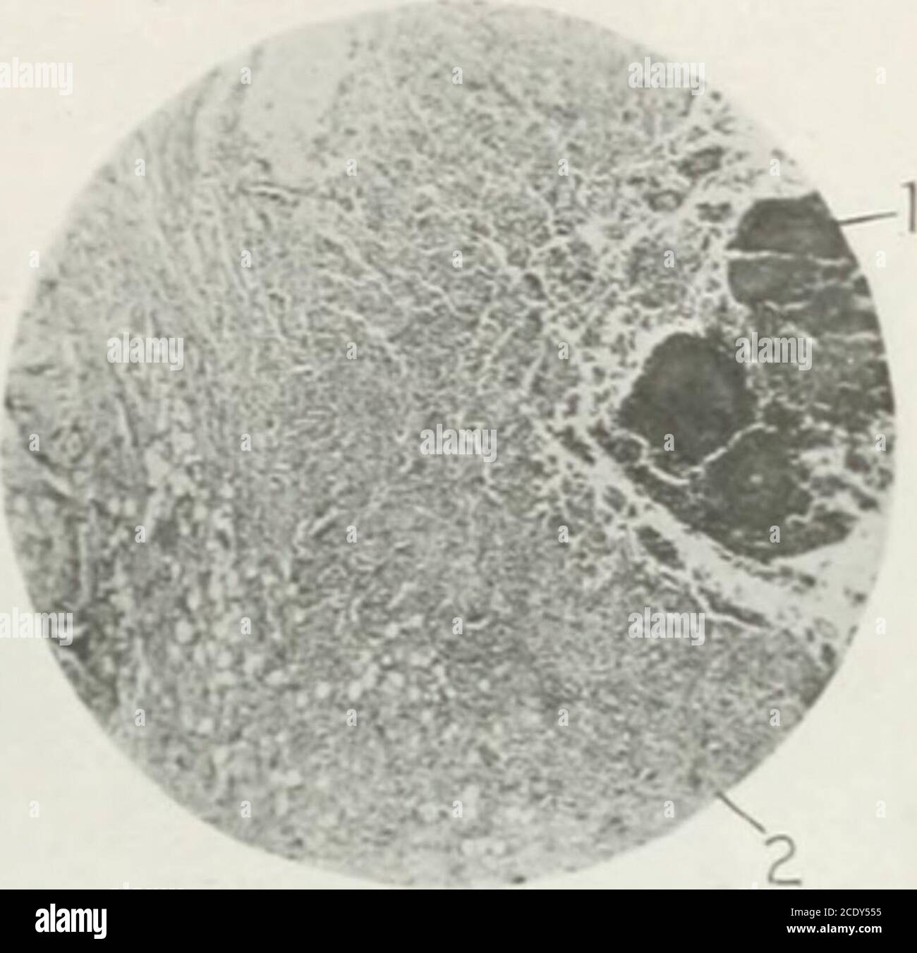. Annals of surgery . Fig. I.—.ppendi. and w.?ppendix ...