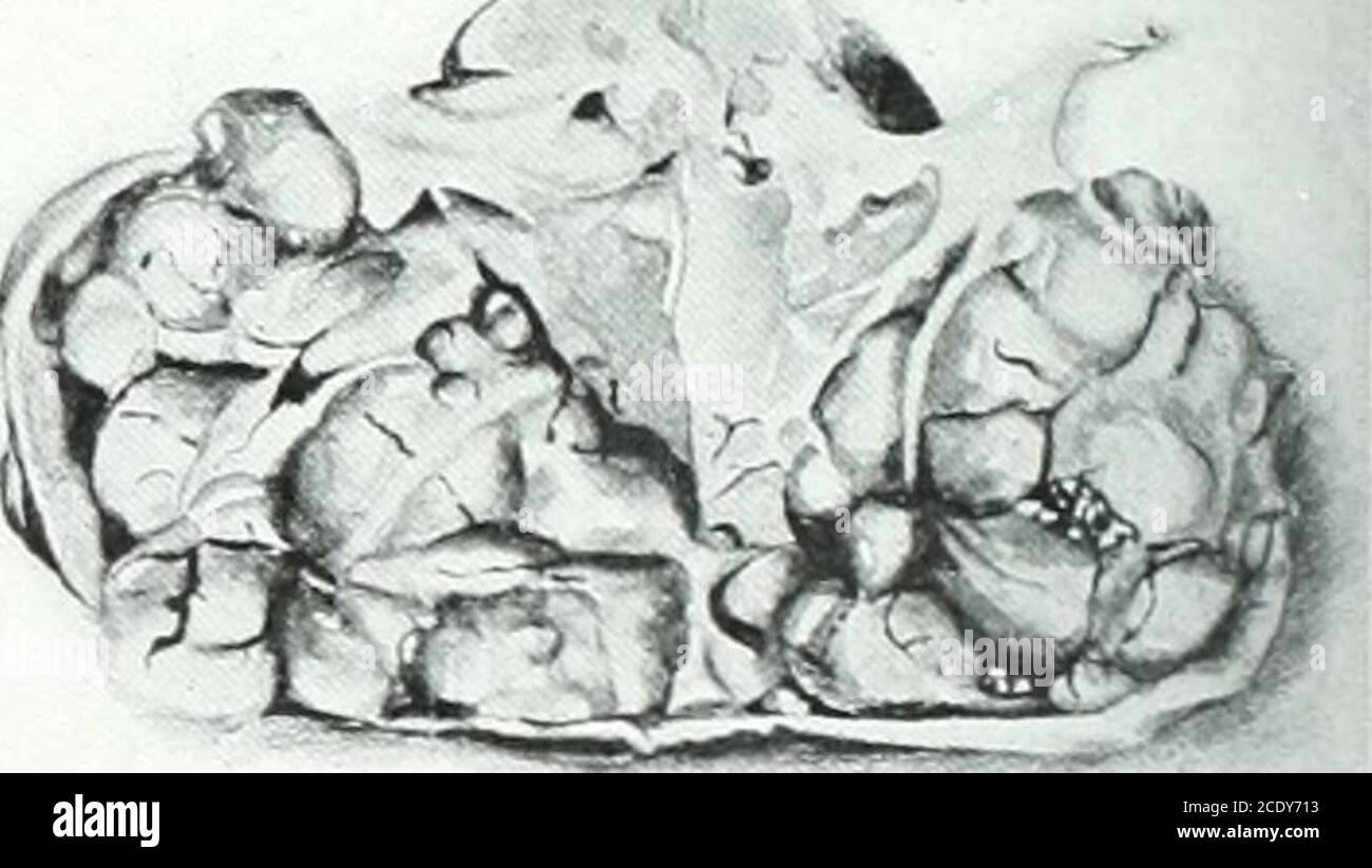 . Annals of surgery . left alone.After operation intensive X ...