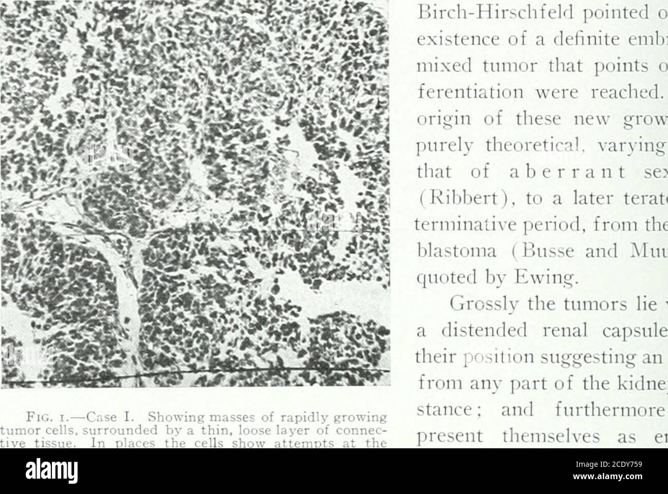 Noma disease hi-res stock photography and images - Alamy