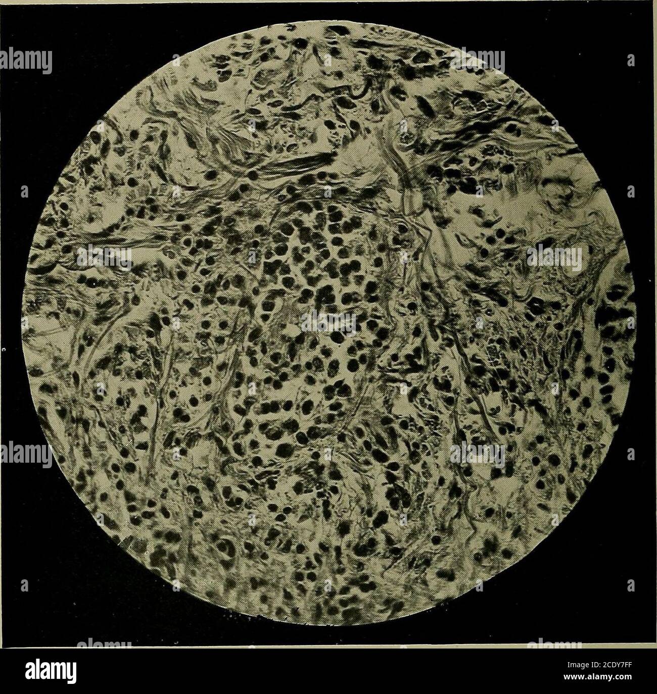 Syphilitic lichen hi-res stock photography and images - Alamy