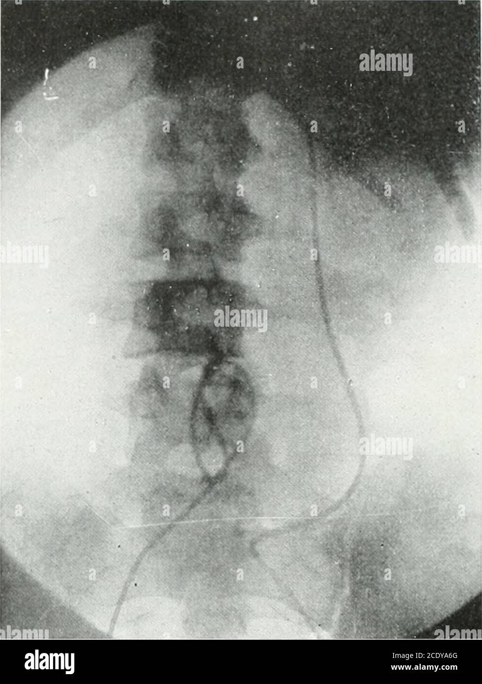 Nephrectomy hi-res stock photography and images - Alamy