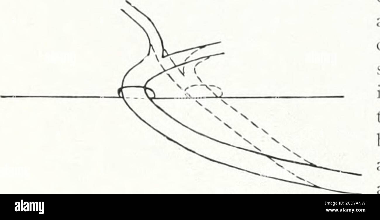. Annals of surgery . es. In the suture of the u]j])er flap of the ...