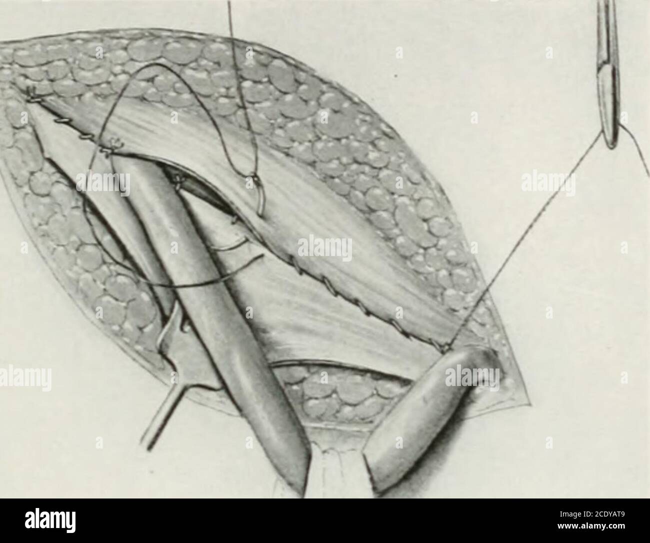 Deep inguinal ring hi-res stock photography and images - Alamy