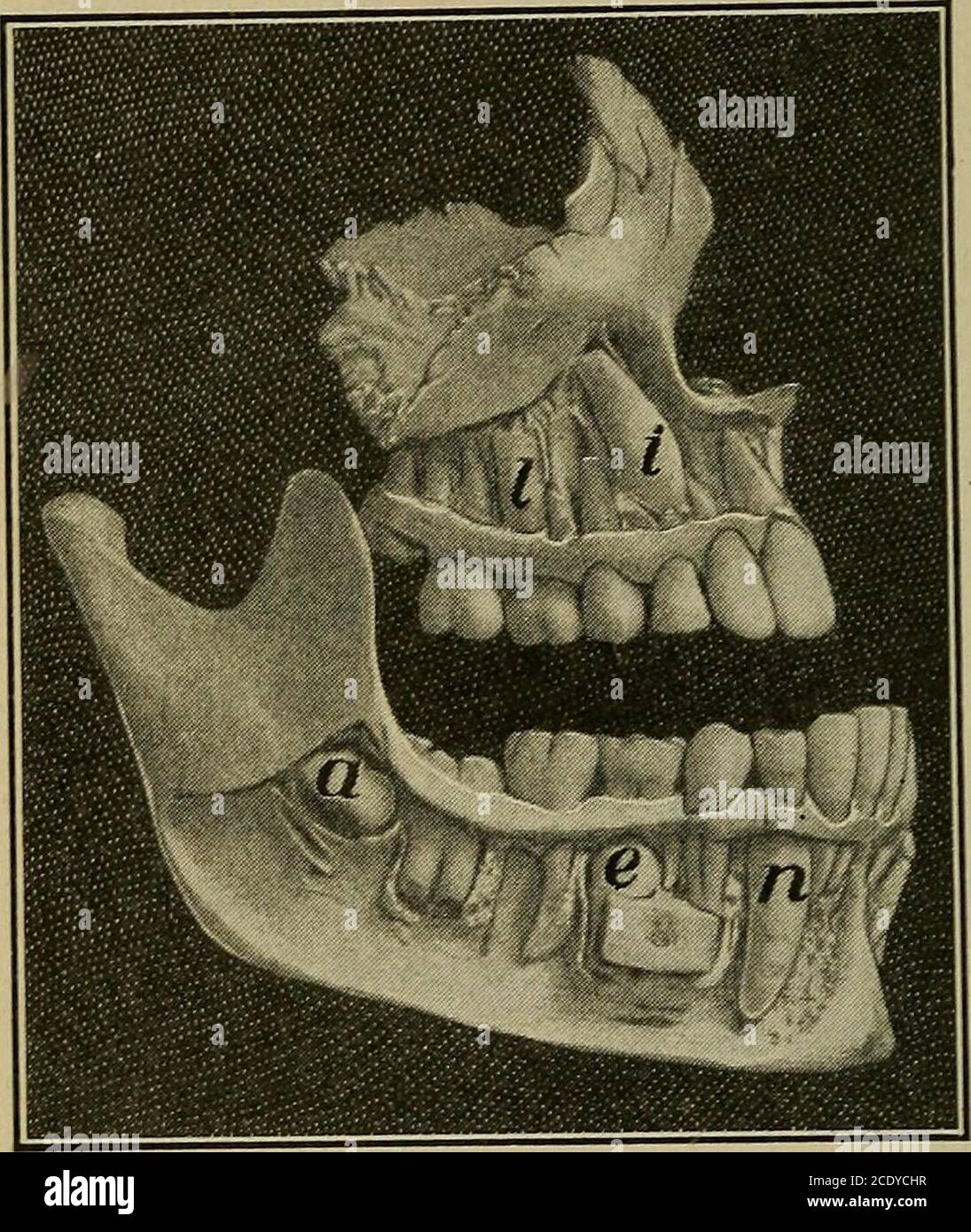 Side Of Bone Coming Through Gum