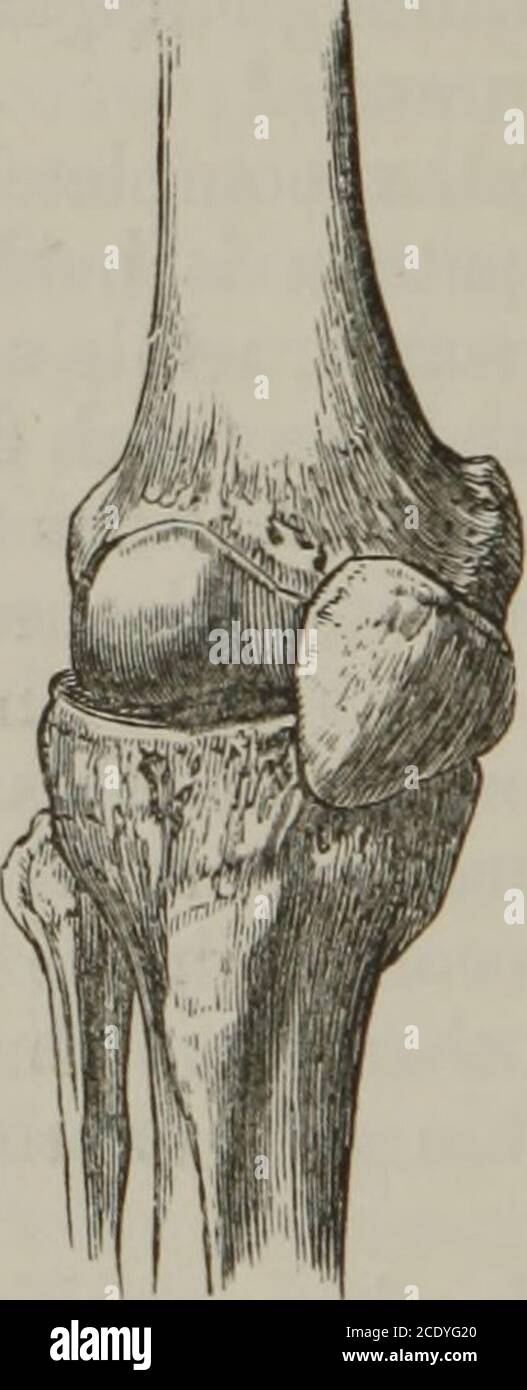 Dislocated patella hi-res stock photography and images - Alamy