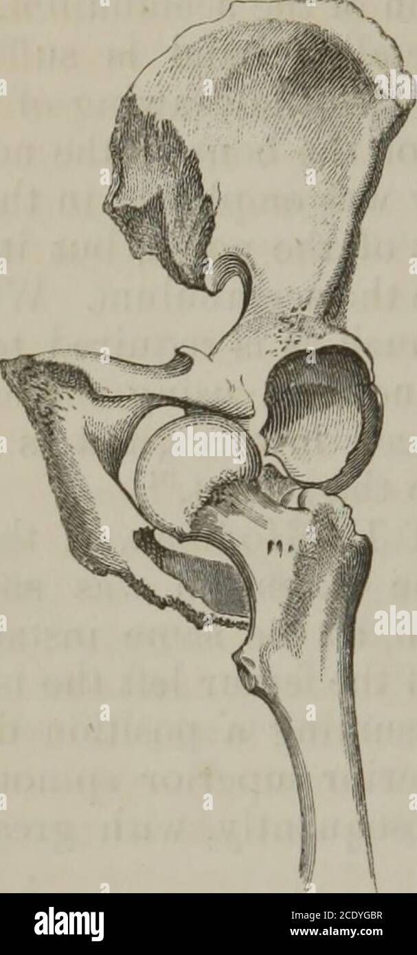 Torn thigh muscle hi-res stock photography and images - Alamy
