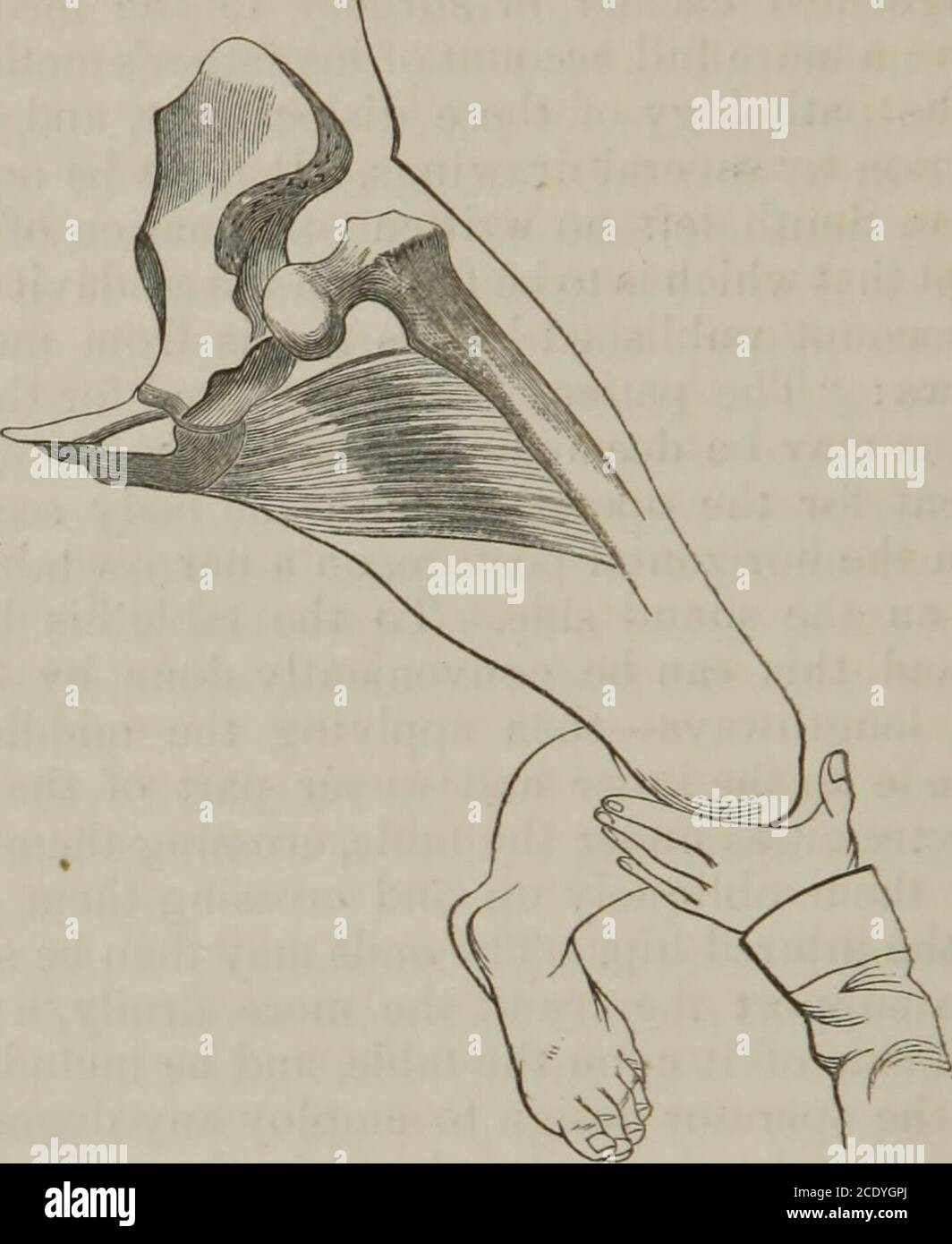. A practical treatise on fractures and dislocations . ctedby pressing ...