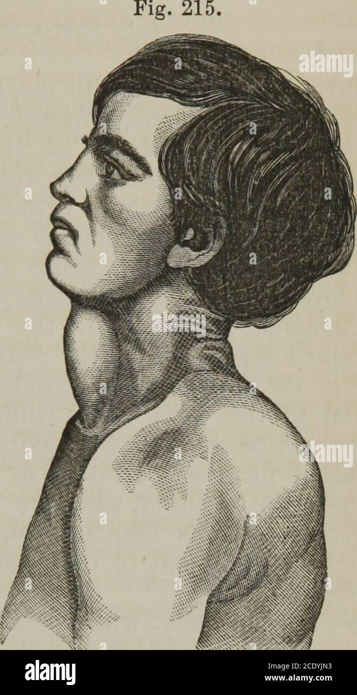 . A practical treatise on fractures and dislocations . The bones were ...