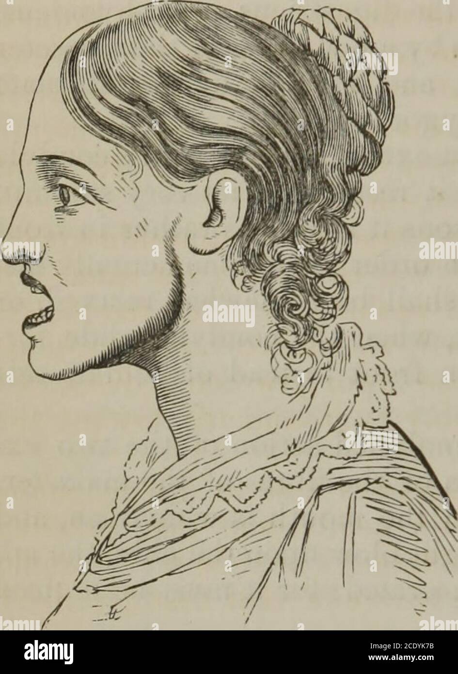 . A practical treatise on fractures and dislocations . Double ...