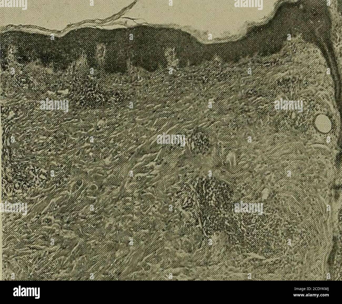 Annular lesions hi-res stock photography and images - Alamy