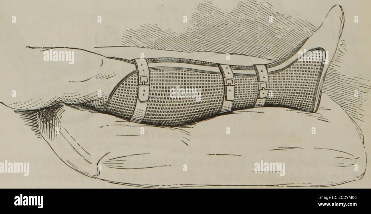 . A practical treatise on fractures and dislocations . These side ...