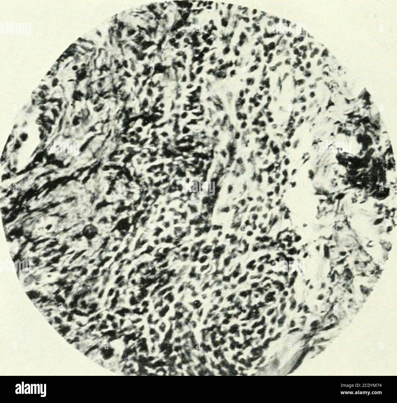 Cutis verticis gyrata hi-res stock photography and images - Alamy