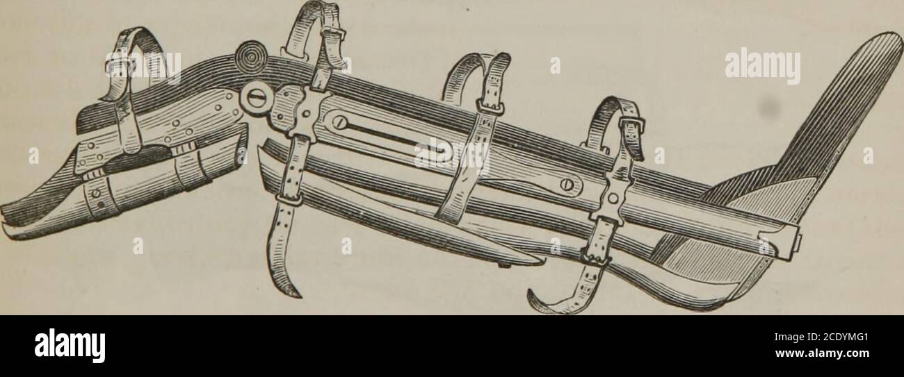 . A practical treatise on fractures and dislocations . Listons double ...
