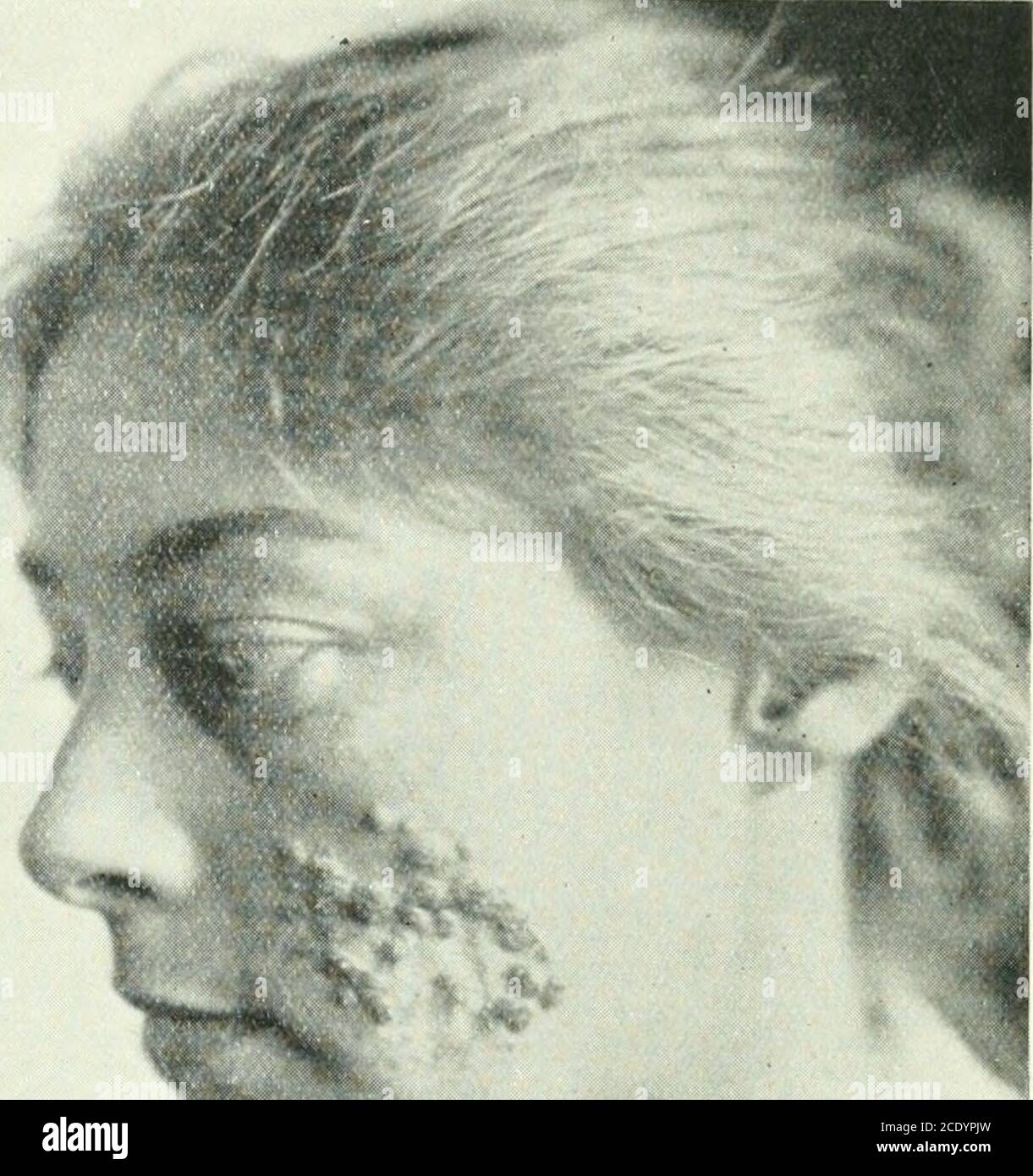 . The British journal of dermatology . leishmaniasis (Oriental sore ...