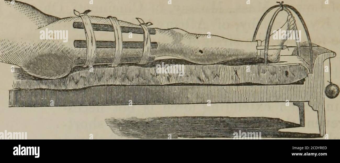 . A practical treatise on fractures and dislocations . straps, and ...