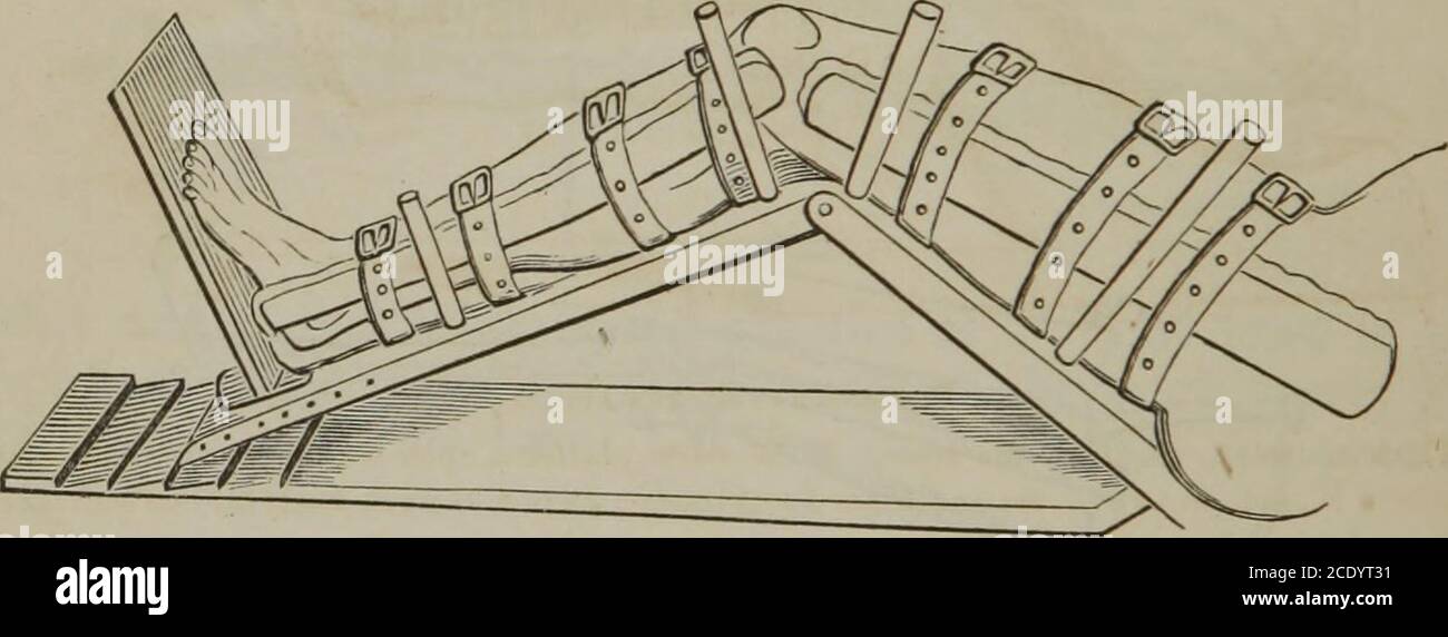 . A practical treatise on fractures and dislocations . B. Welchs Thigh ...