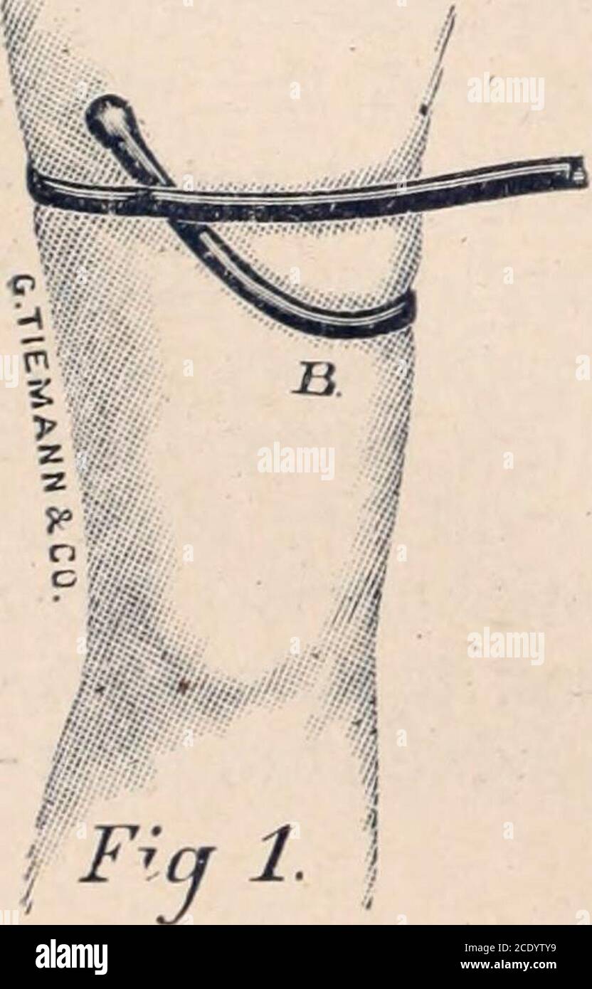 Axis traction forceps hi-res stock photography and images - Alamy