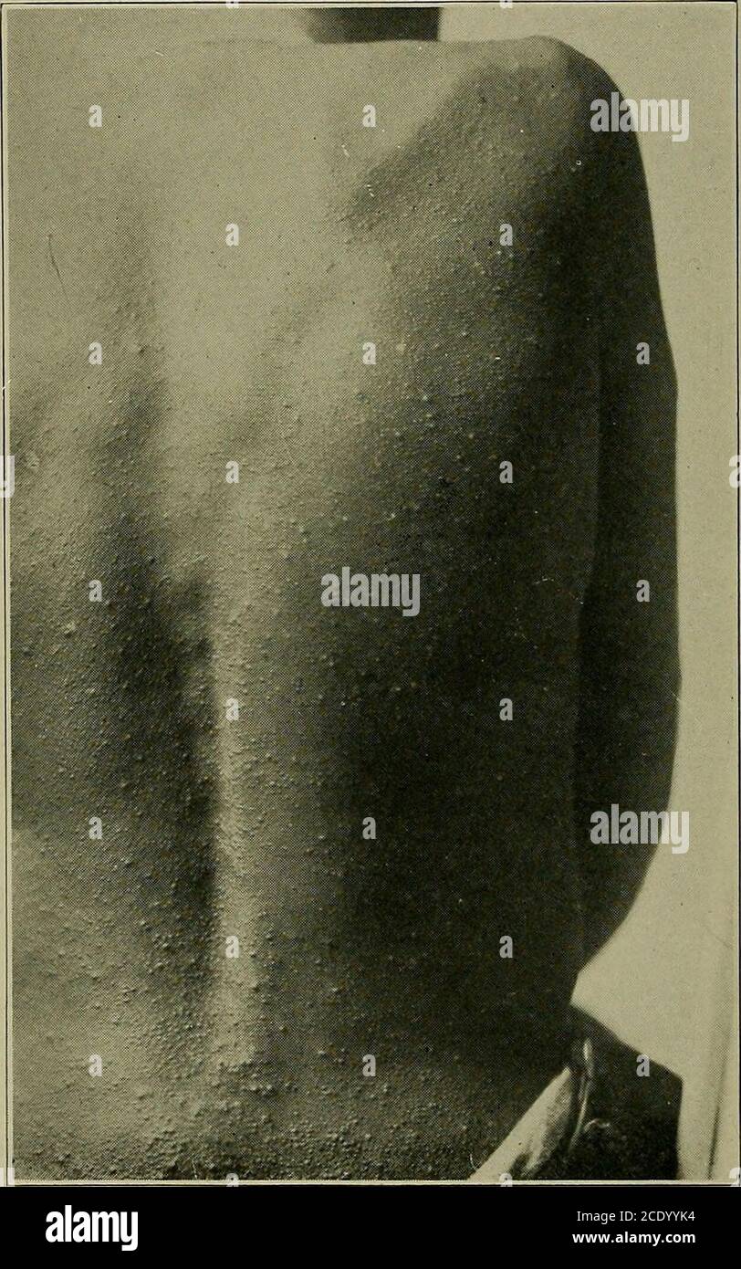. Syphilis : a treatise on etiology, pathology, diagnosis, prognosis ...