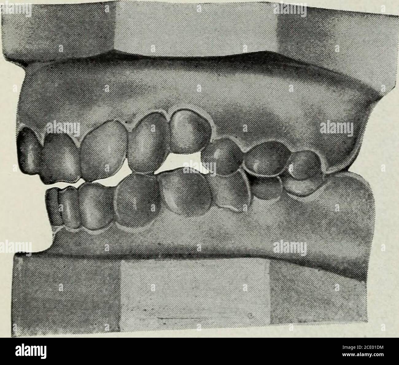 Purulent Exudate Teeth