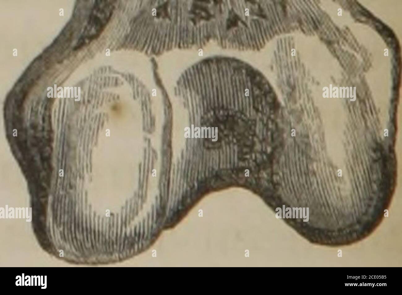 Broken bone callus hi-res stock photography and images - Alamy