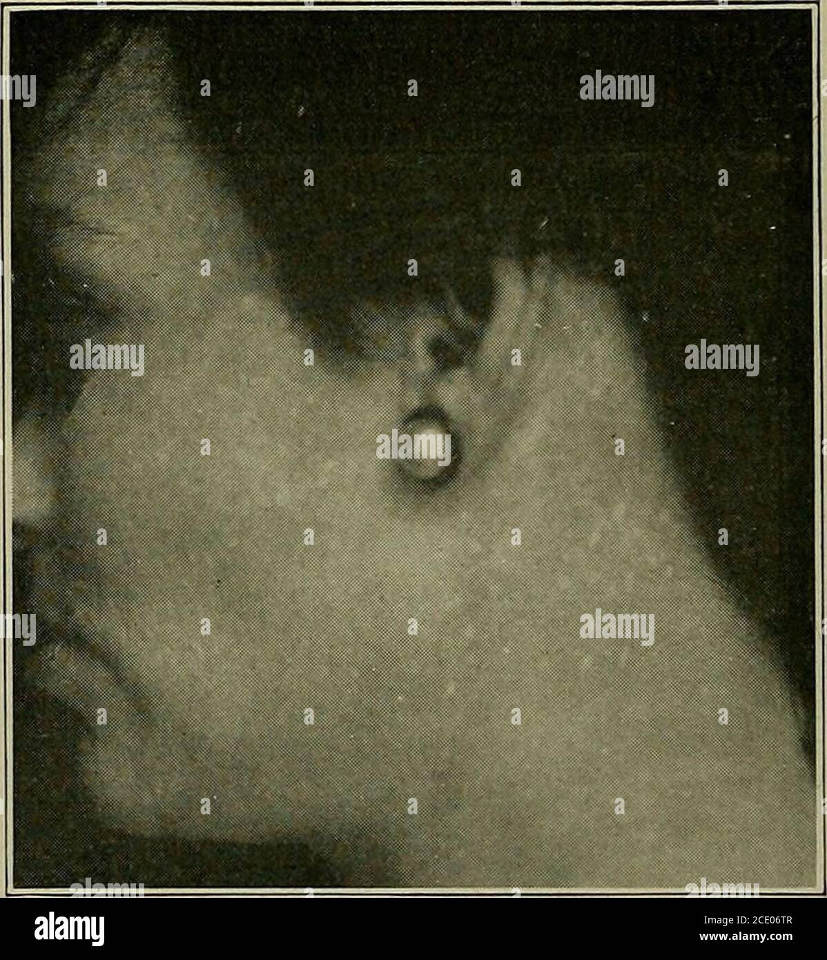 Leucoderma hi-res stock photography and images - Alamy