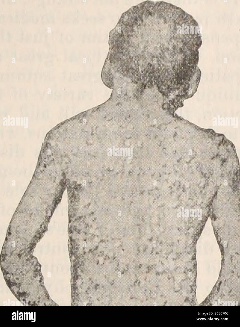Small pox case hi-res stock photography and images - Alamy
