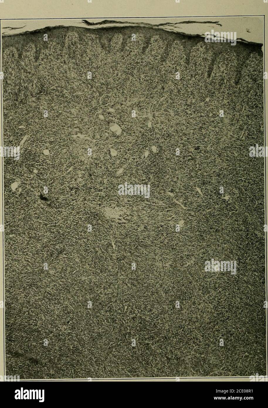 . Syphilis : a treatise on etiology, pathology, diagnosis, prognosis ...