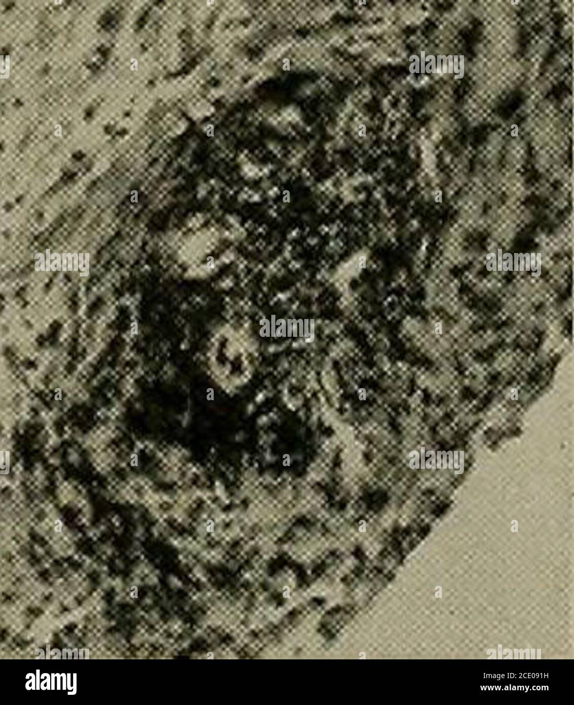 Syphilis chancre hi-res stock photography and images - Alamy