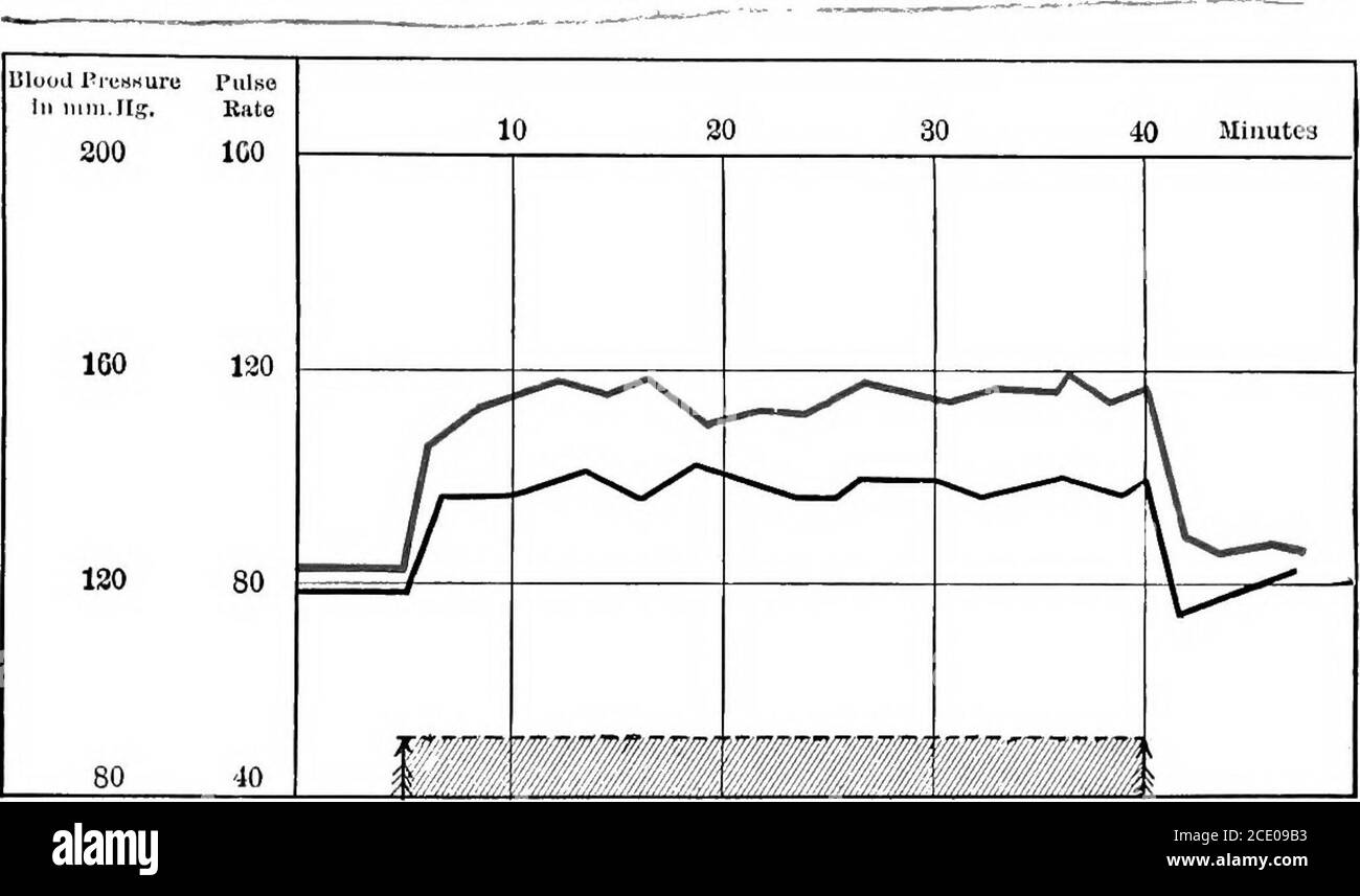 Decreased blood pressure Black and White Stock Photos & Images - Alamy