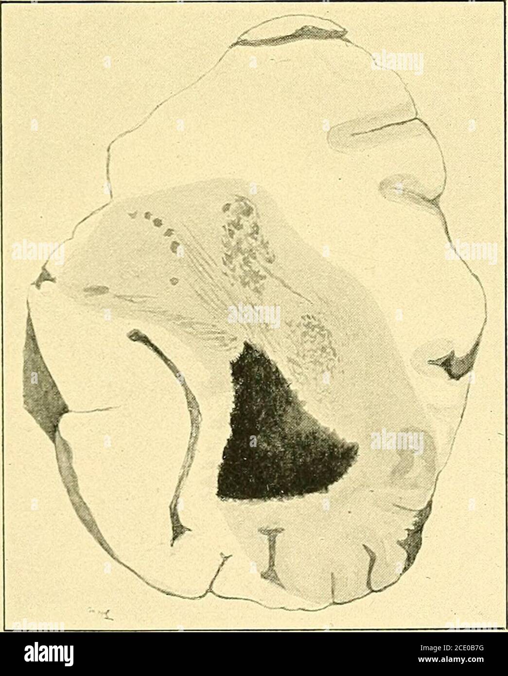 Occipital skull fracture hi-res stock photography and images - Alamy