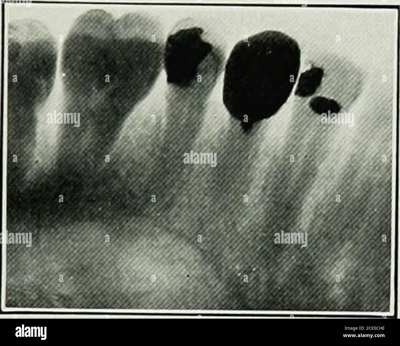 Radiolucent Rarefying Osteitis