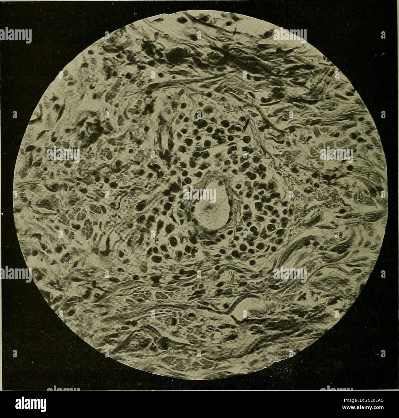Scar tissue formation hi-res stock photography and images - Alamy