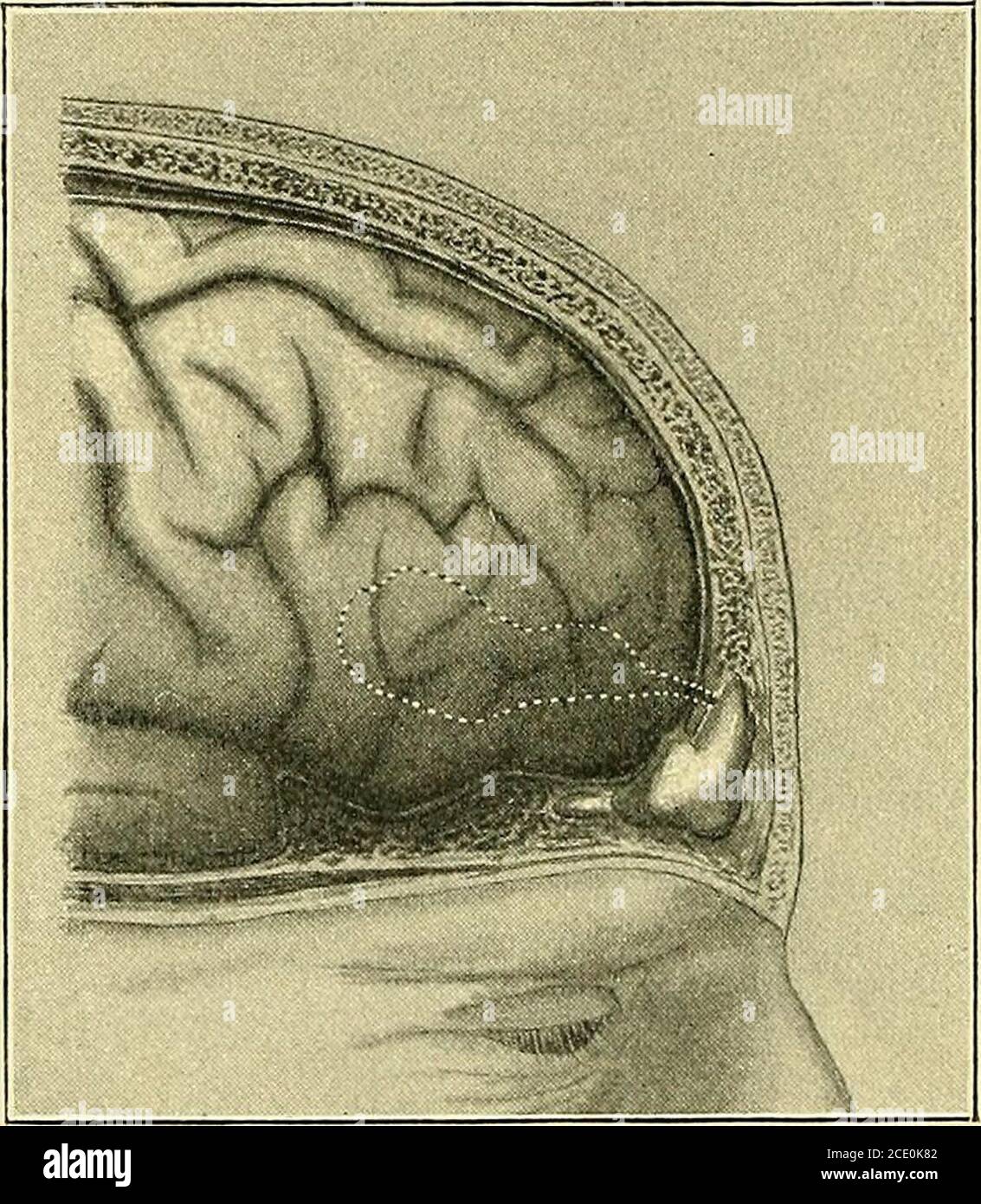 Open brain surgery hi-res stock photography and images - Alamy