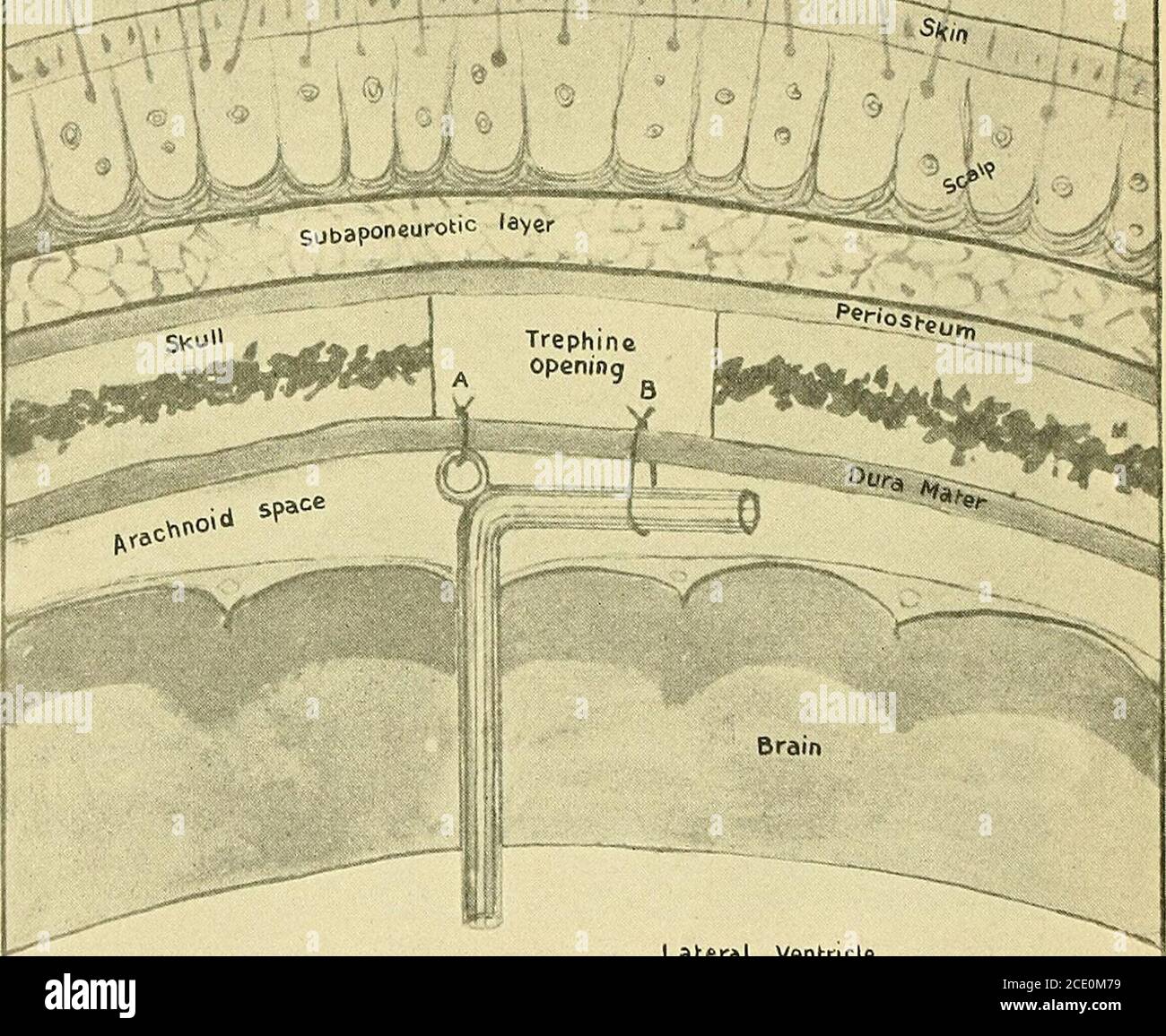 Opisthotonus hi-res stock photography and images - Alamy