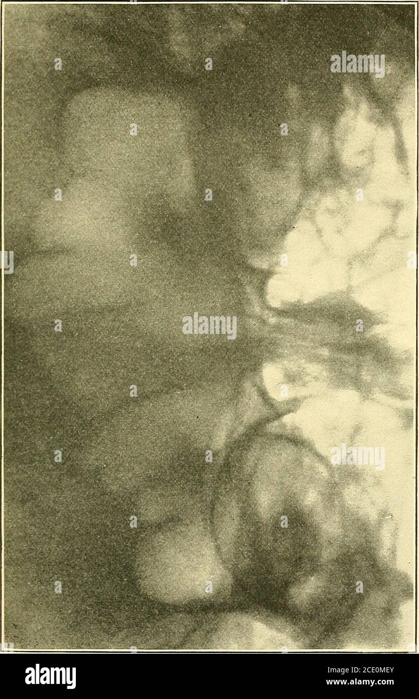 Tubercular glands hi-res stock photography and images - Alamy